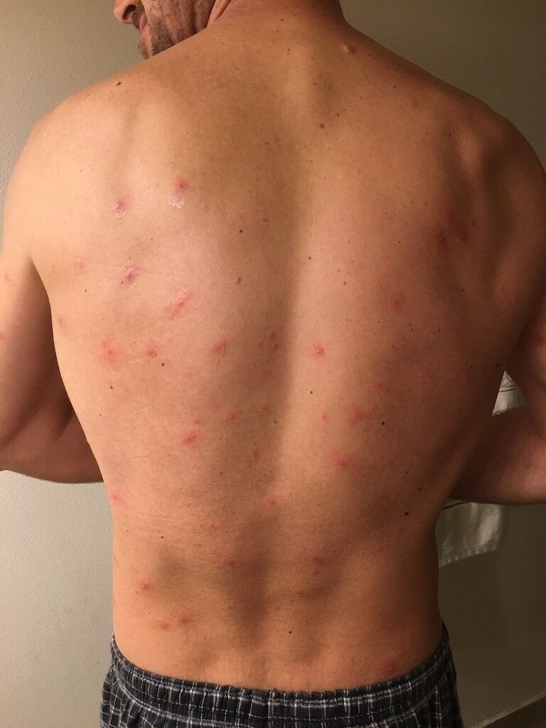 straw itch mite control and treatments for the home yard and garden